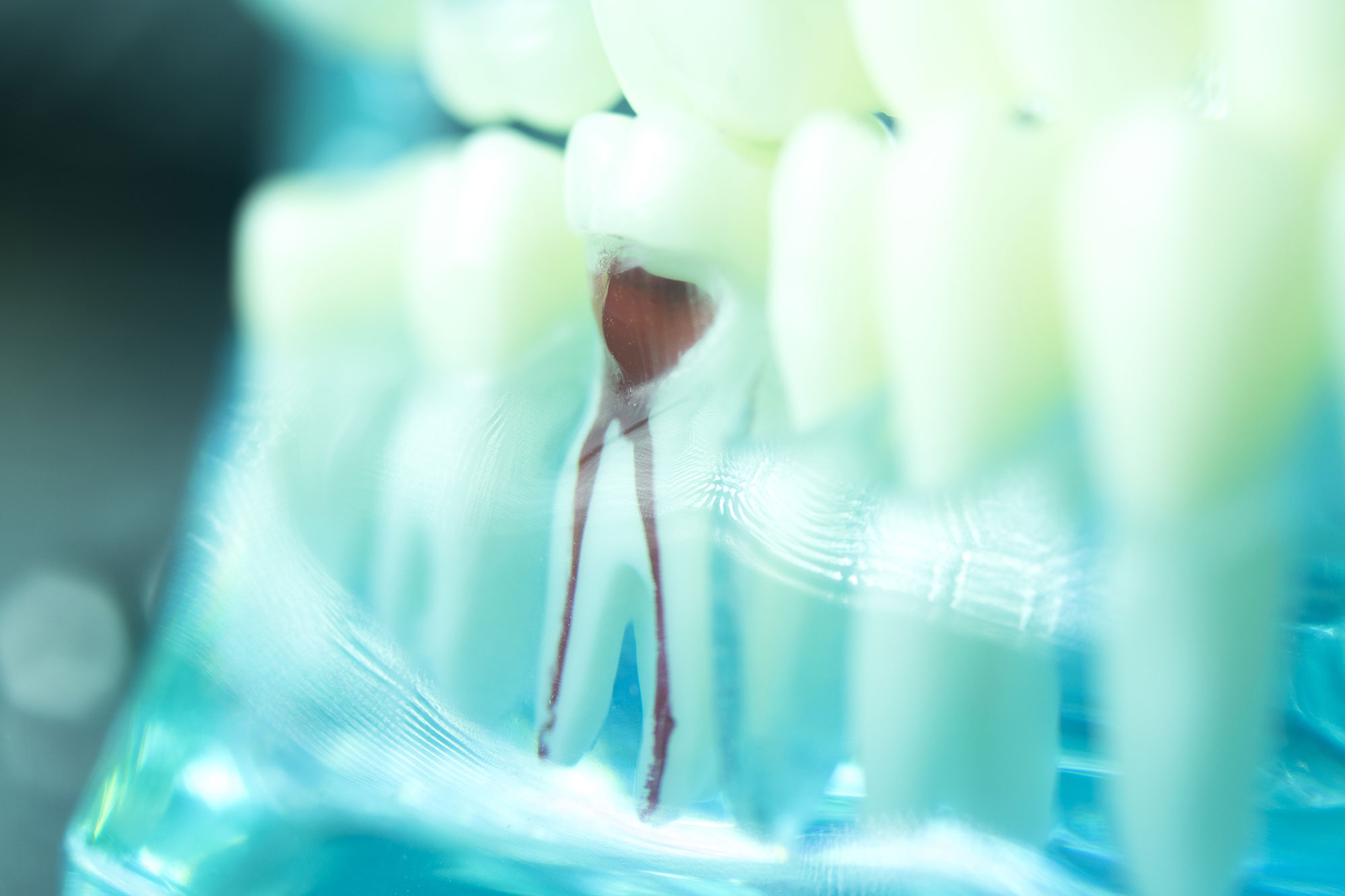 Root Canal Streetsboro Oh Elyria Oh Signature Smiles Dental 5087